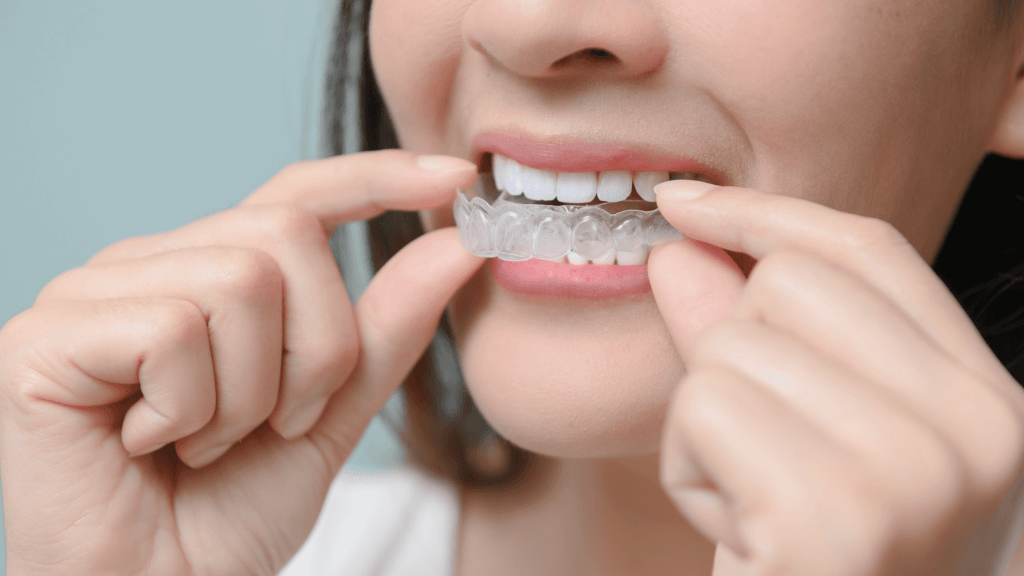 Invisalign® Aligners and Teeth Whitening: Can You Do Both at the Same Time?